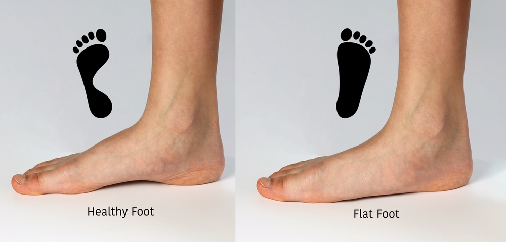 Understanding Orthotics: How They Improve Foot Health and Mobility ...